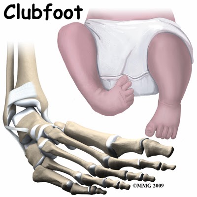 Anna-Mart Kruger Physiotherapy: Clubfoot