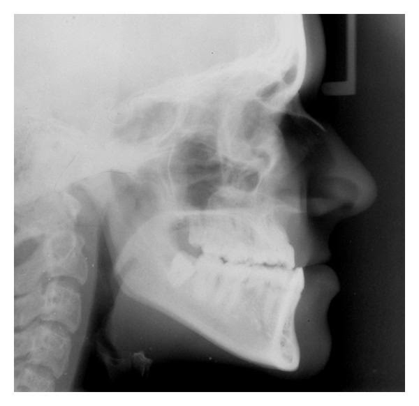 Miranza IOA: SÍNDROME DE AXENFELD-RIEGER