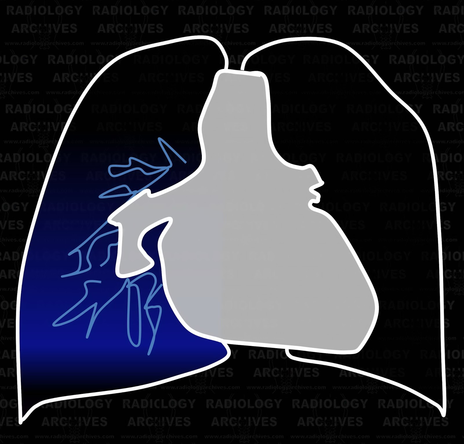 Radiology Archives: Πνευμονική Εμβολή (Σημείο Westermark)