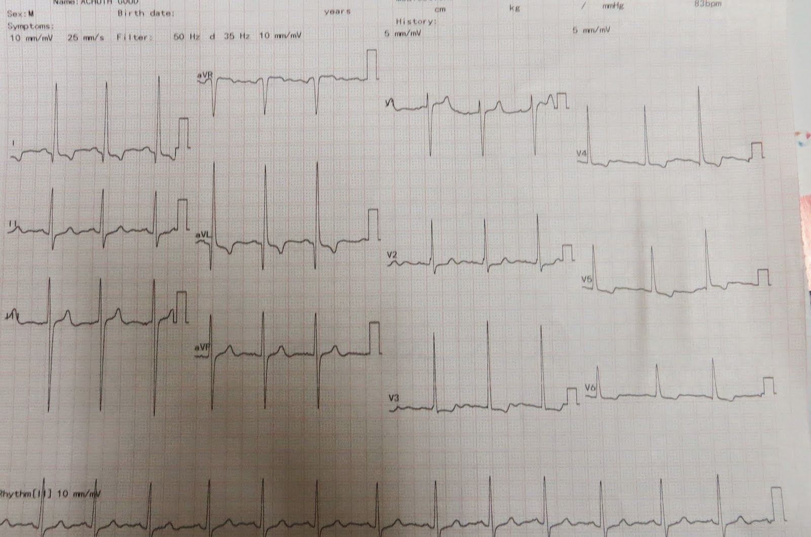 HealthforHeart: Counterclockwise loop in the 12 ECG of tricuspid atresia