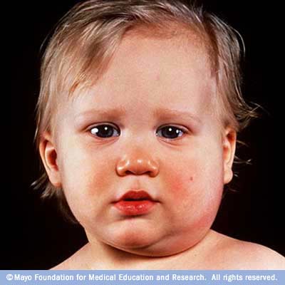 Medicine for health care: Mumps