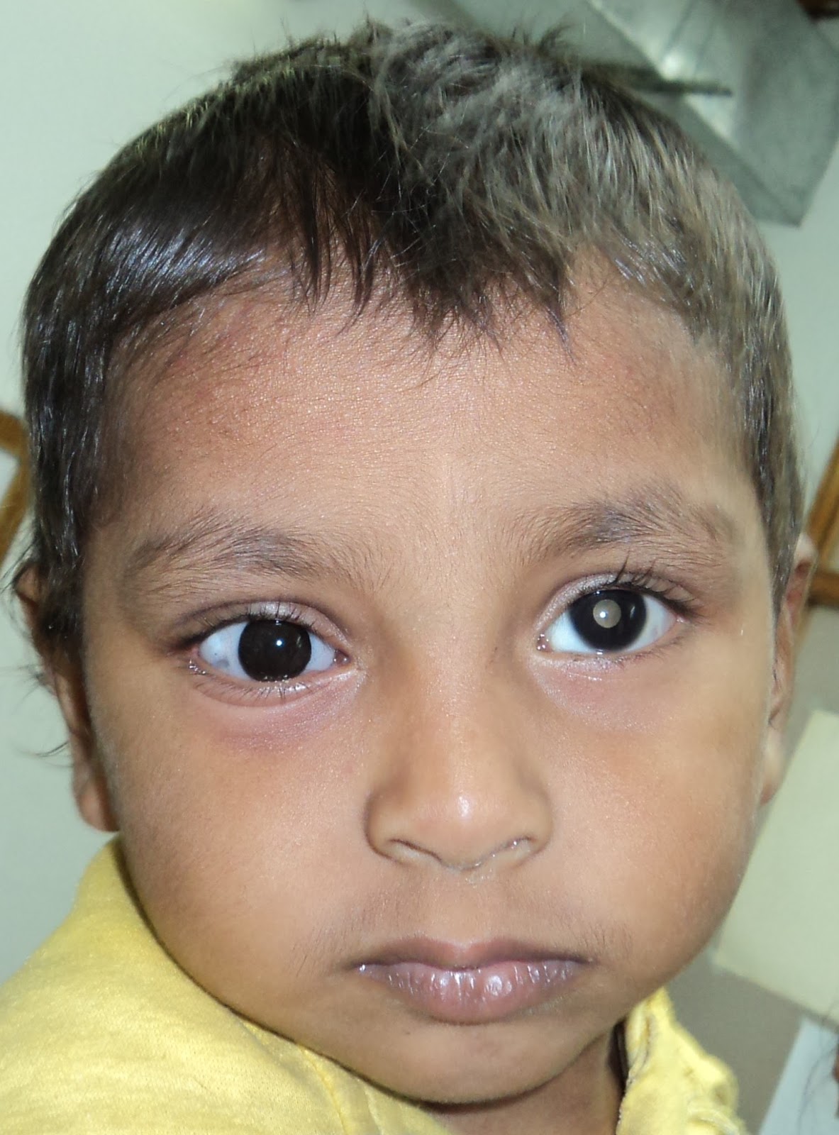 Ocularist in Kolkata: KARUNAMAYEE PROSTHETIC EYE CLINIC