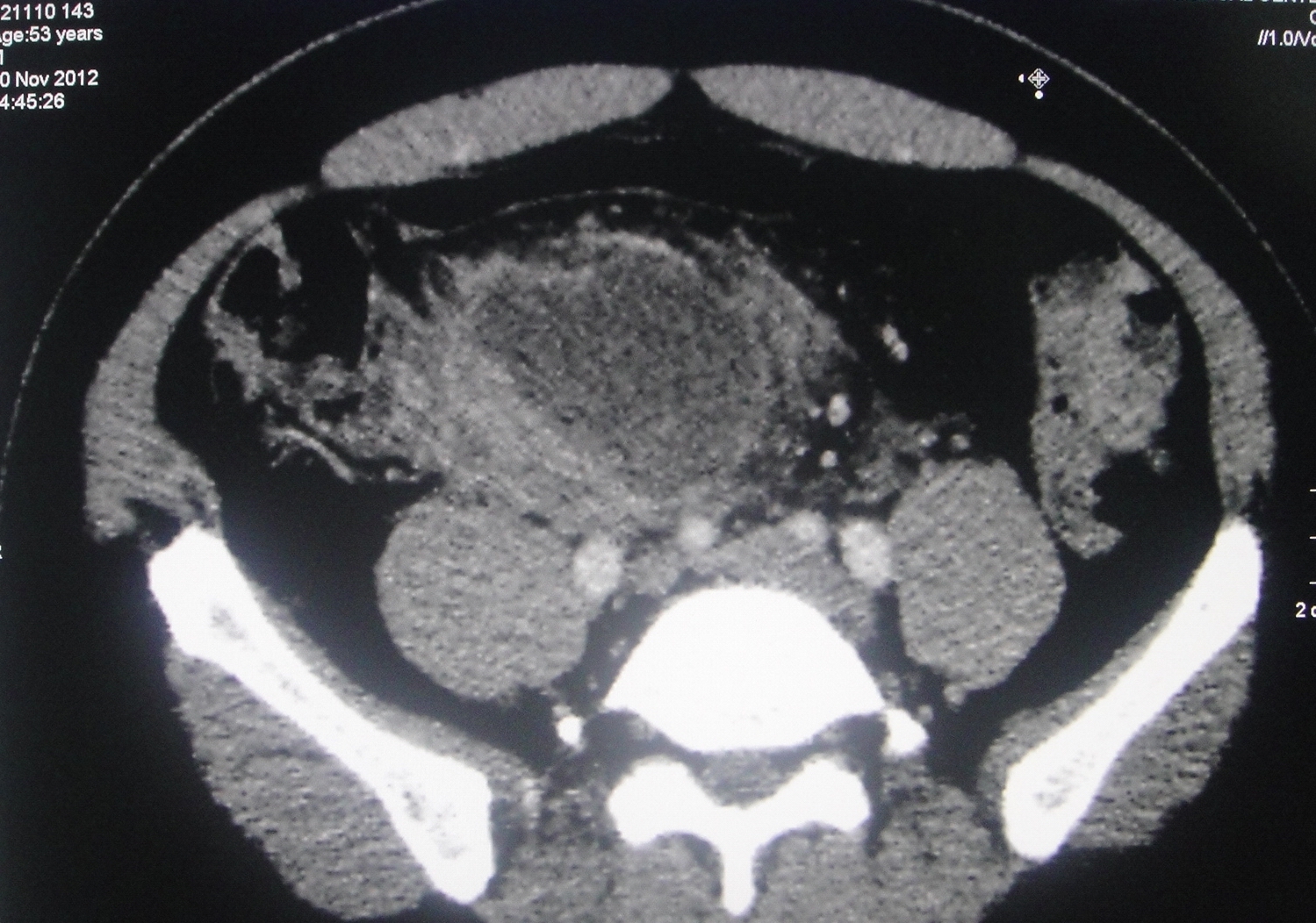 VIETNAMESE MEDIC ULTRASOUND: CASE 150: PERIUMBILICAL MASS, Dr PHAN ...