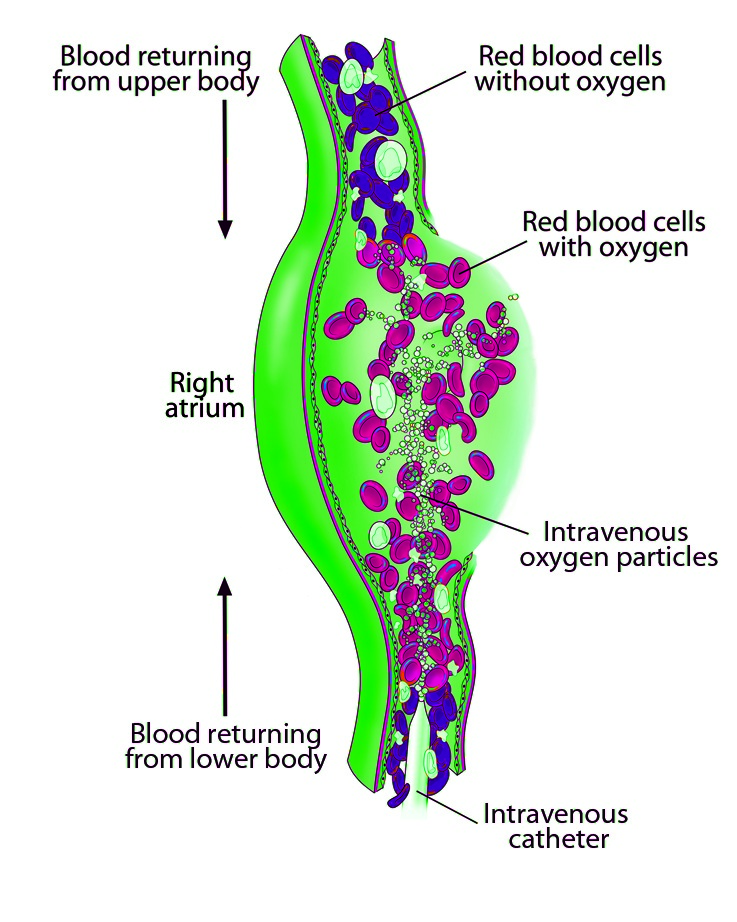 Injectable oxygen | NextBigFuture.com