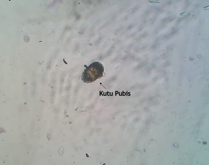 Sedimen Urine Metode Pewarnaan (Stainning) | Analis Kesehatan