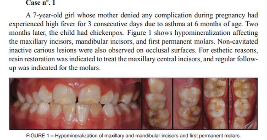 Enamel Hypomineralization Treatment Bauer Smiles