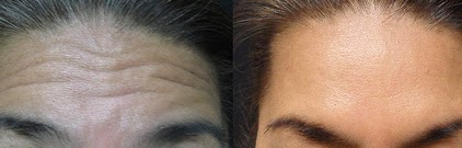 Natural Facelift Techniques To Look Younger With Face Yoga Exercises ...