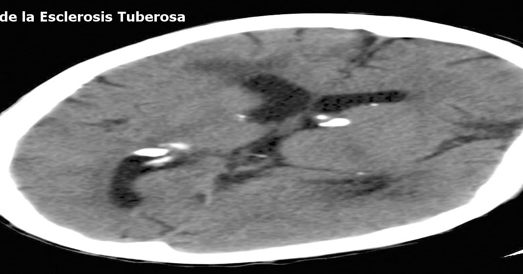 Salud Y Profesionales: 15 mayo : Día Mundial de la Esclerosis Tuberosa