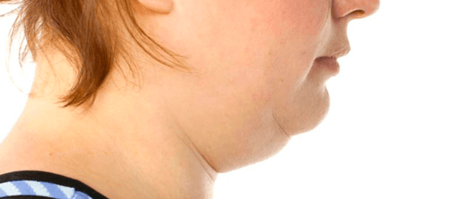 Remedios caseros para eliminar la papada naturalmente