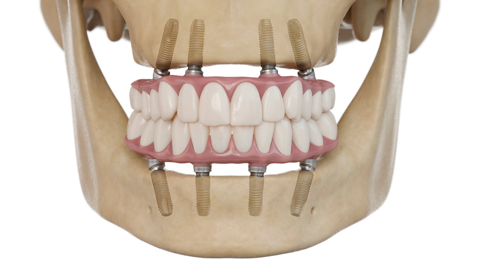 Supporting the full implant treatment process - from planning to final ...
