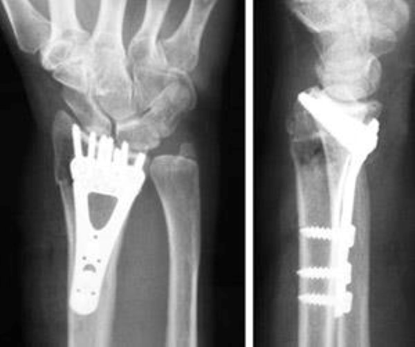Distal Bone Fracture Surgery | Fractured Distal Healing Time