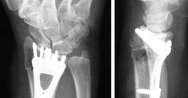 Distal Bone Fracture Surgery | Fractured Distal Healing Time