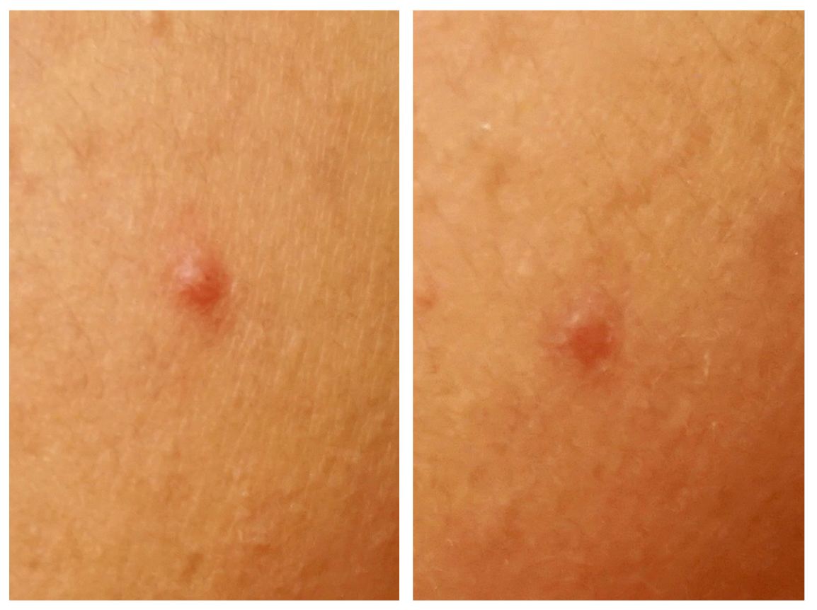 Quick Fix For Zits: Belo Essentials AcnePro