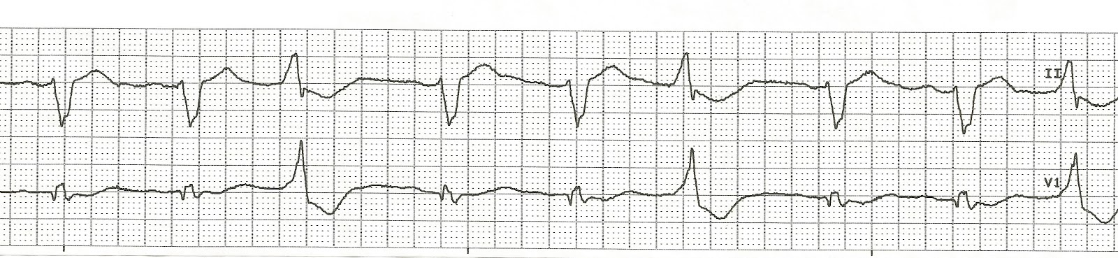 EKG Rhythm Strips 81: Bigeminy, Trigeminy, Quadrigeminy...