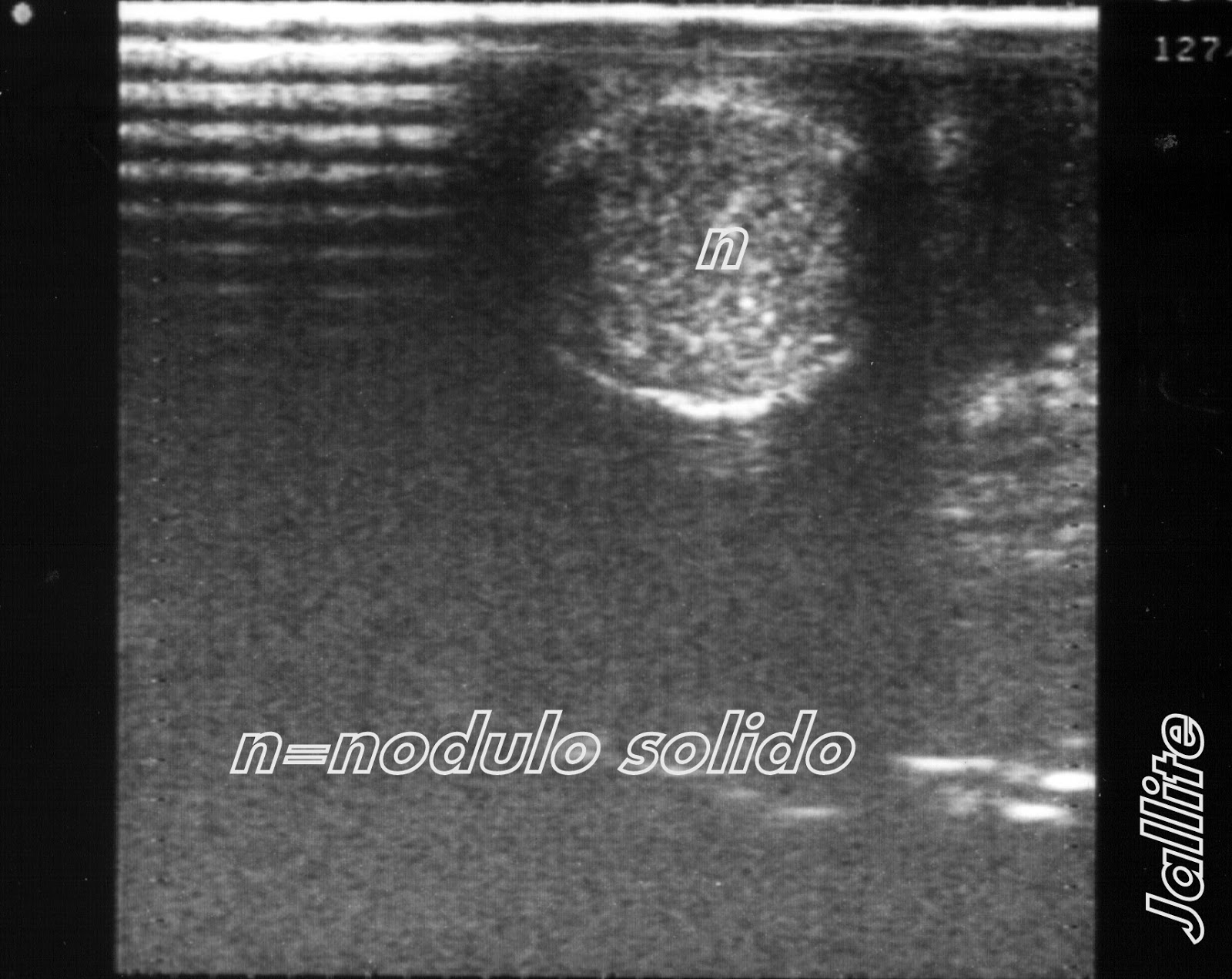 Tumor Extra-Testicular