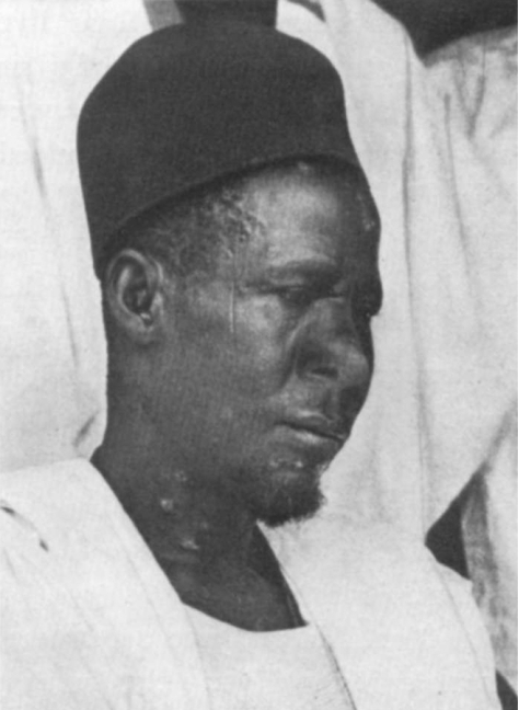 Febre amarela e Max Theiler : Prêmio Nobel pelo desenvolvimento de uma ...