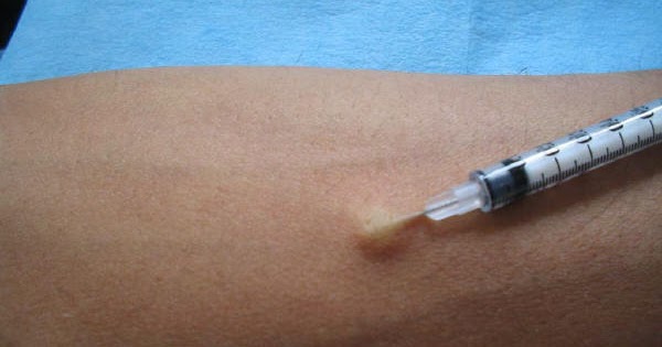 ADMINISTRACIÓN DE MEDICACIÓN: Vía intradérmica