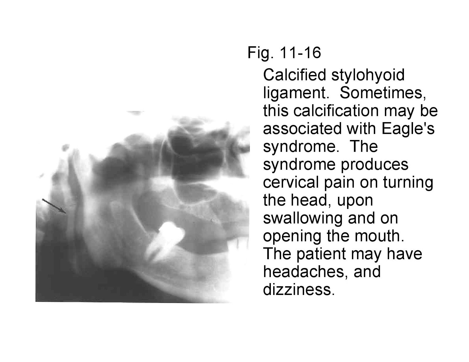 Dentistry and Medicine: SOFT TISSUE CALCIFICATIONS IN ORO-MAXILLO ...