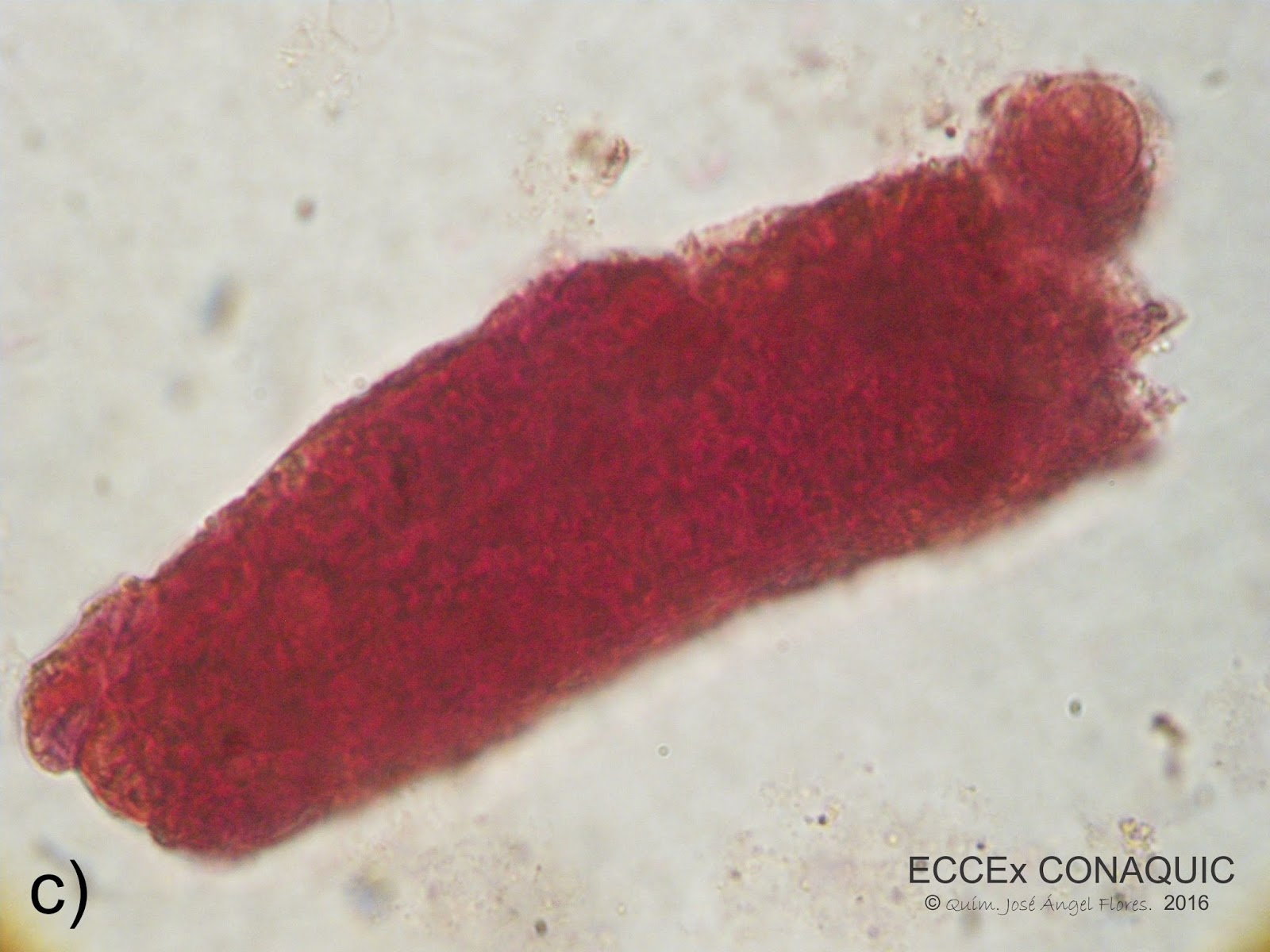 Examen General de Orina: Caso UR-enero-16 (Enfoque: cilindruria)