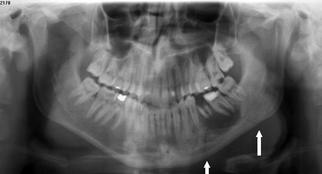 Fracture pathologique de la mandibule Pathological mandibular fracture