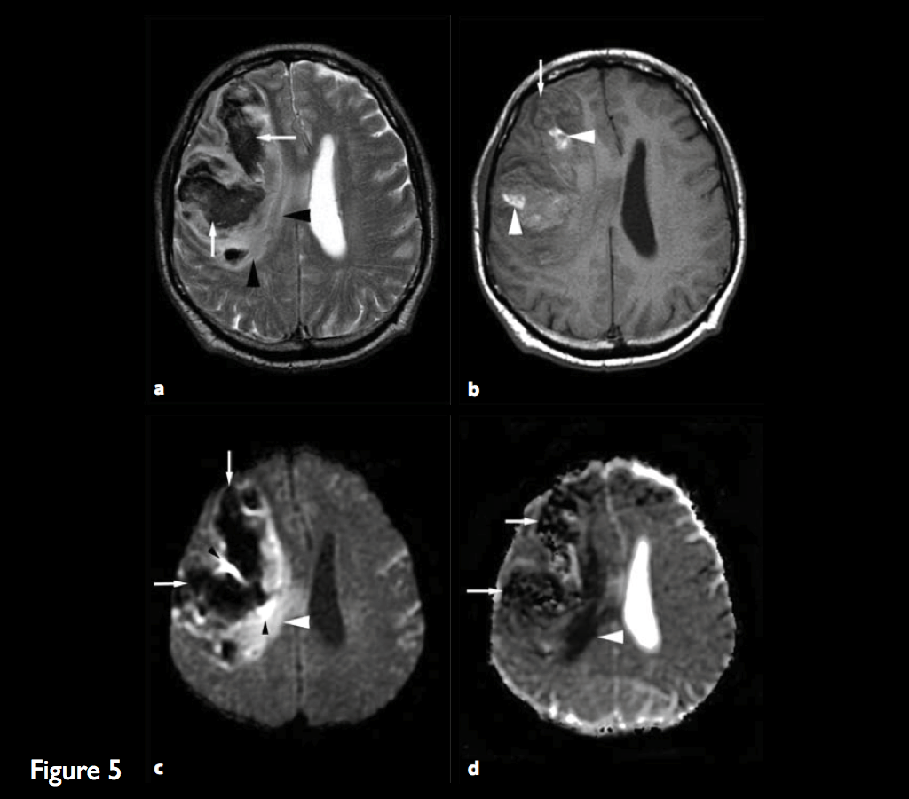 MRI BLOG: Pitfalls of Diffusion Weighted Imaging