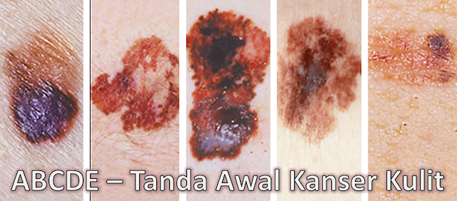 ABCDE - Kenali Tanda-tanda Awal Kanser Kulit