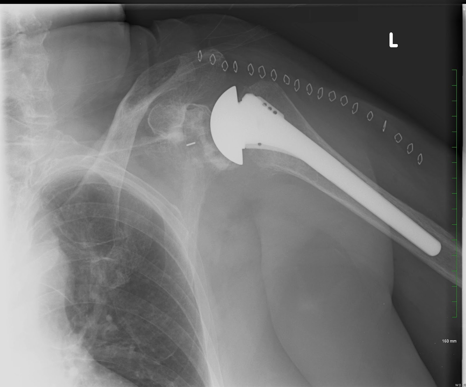 Shoulder and Elbow Surgery: Early radiolucent lines after glenoid ...