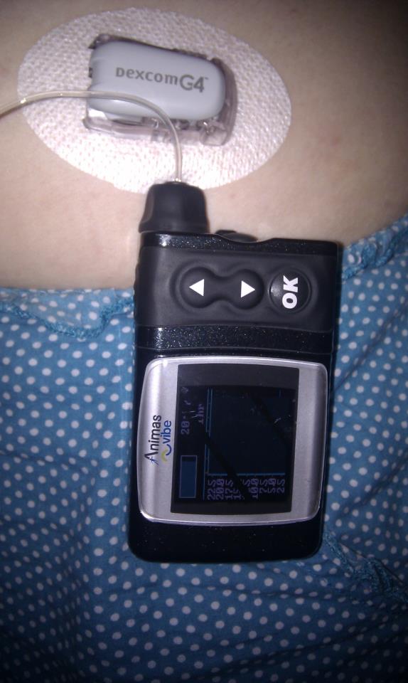 click of the light: Dexcom G4 trial