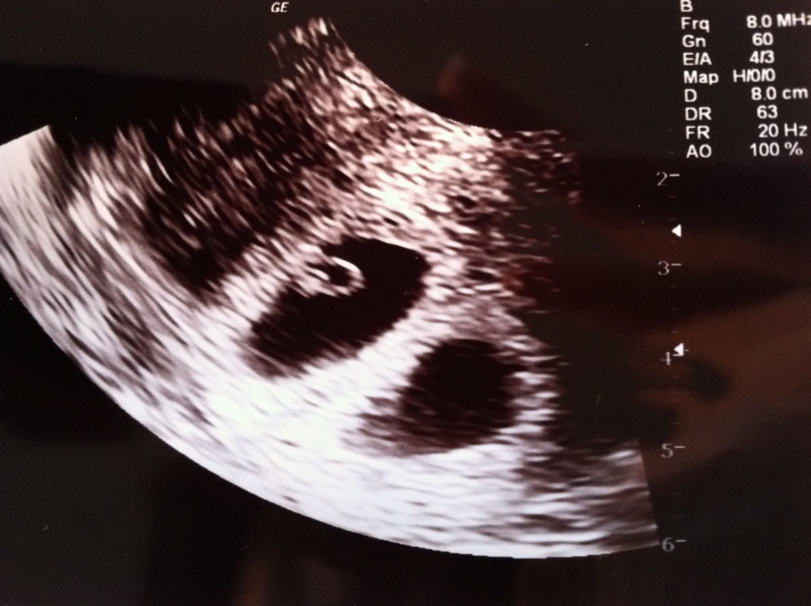 Infertile in the City: 6 weeks 2 days - Ultrasound Report