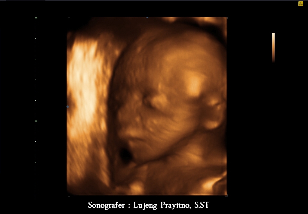 USG 4 DIMENSI: Lengkap Tentang USG 2 Dimensi, 3 Dimensi dan 4 Dimensi