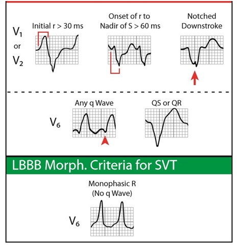 ECG Rhythms: Practical Approach of Wide Complex Tachycardia in Cardiac ...