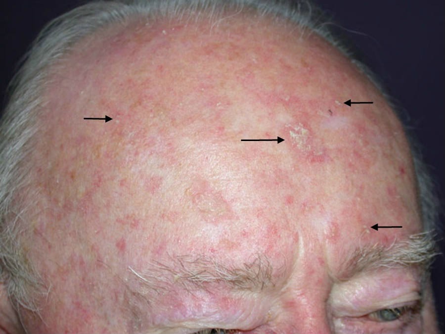 DE GUARDIA EN URGENCIAS: Queratosis Actínica