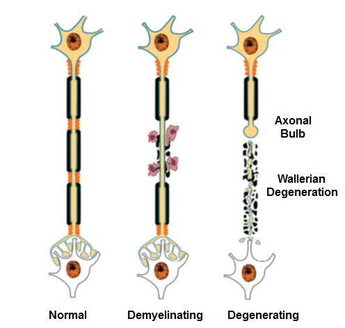 Multiple Sclerosis Research: Education: Inflammation-Chicken or Egg ...