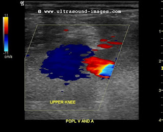 cochinblogs: Ultrasound imaging of popliteal vein thrombosis