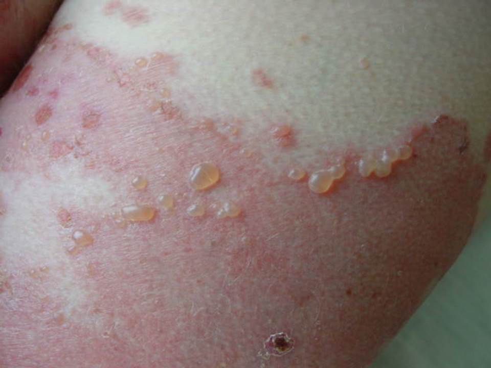 Teaching Dermatology GP Edition: Vesicles and Blisters