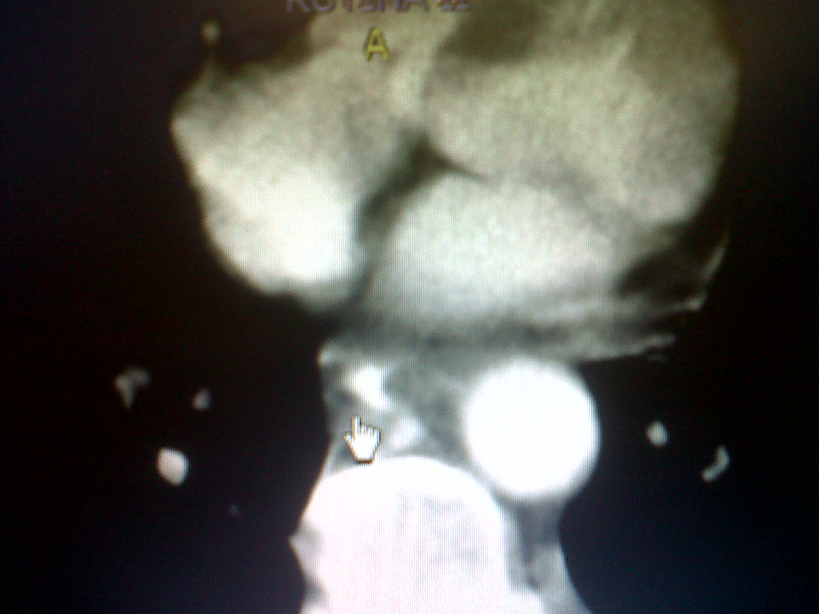 Endoscopia y Cirugía Digestiva: PACIENTE CON DISFAGIA Y LESION ...