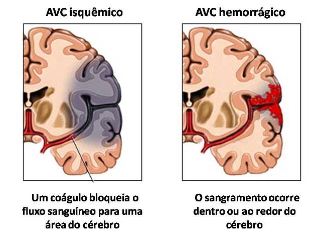 CLÍNICA ALPINO: Você sabe o que significa um AVC ( Acidente Vascular ...