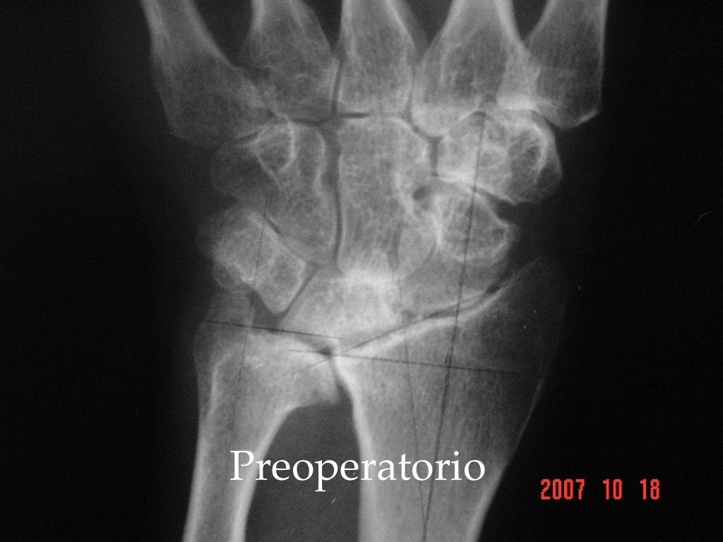 OSSA CARPALIA ©: octubre 2011