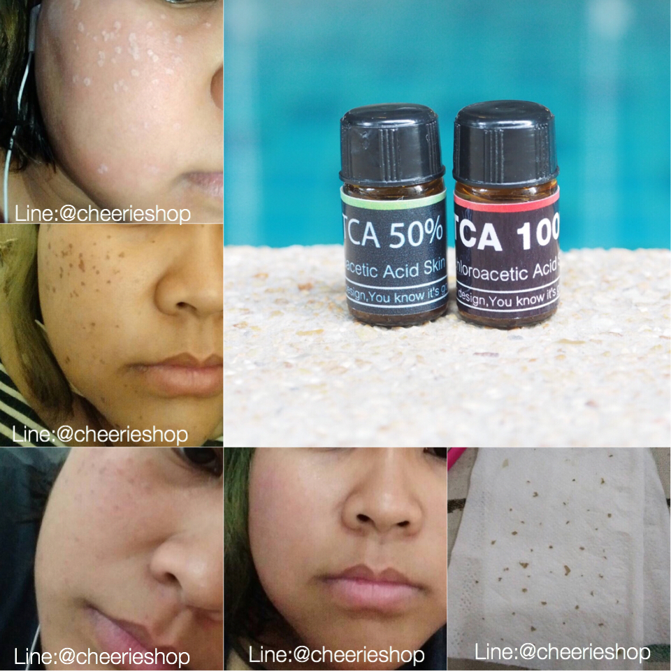 กรดTCA 100% 50% ใช้อย่างไร ให้เกิดประโยชน์ ไม่นำโทษมาให้เคืองใจ