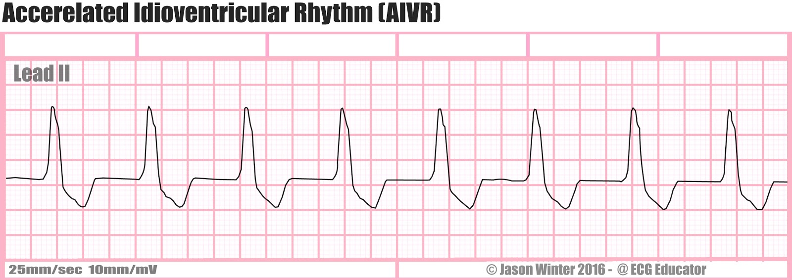 ECG Educator Blog : Accelerated Idioventricular Rhythm (AIVR)