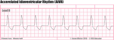 ECG Educator Blog : Accelerated Idioventricular Rhythm (AIVR)