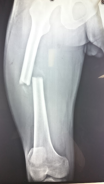 O R T O C R I T I C A: FRACTURA DE FEMUR TRAS CONTUSION DIRECTA. AUTOR ...