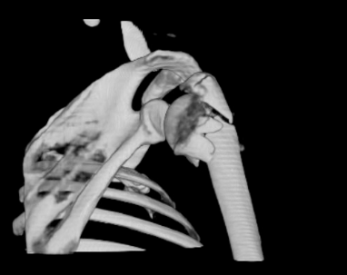 Shoulder and Elbow Surgery: Shoulder subluxation after fixation of ...