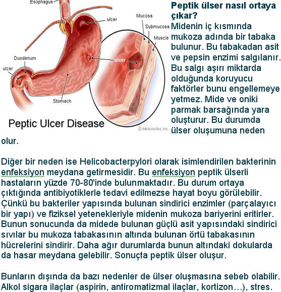 Para Kazan : Ülser nedir tedavisi mide ülseri tedavisi ülser nedir