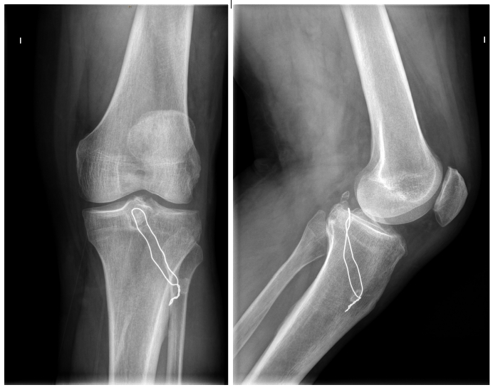 El Blog de Isa y Juan: Fractura de la espina tibial