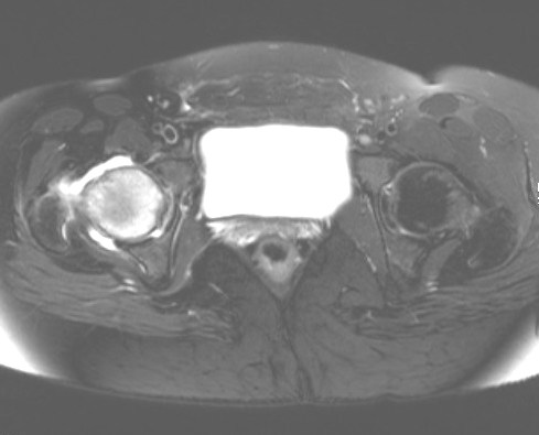 Transient bone marrow oedema of the hip-MRI - Sumer's Radiology Blog