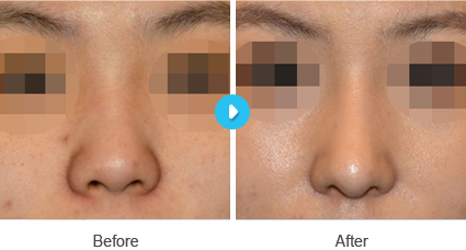 [Nose:Rhinoplasty] Upturned Nose Correction
