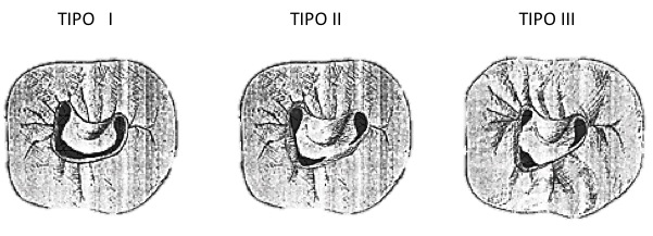 BLOG DE LA CATEDRA DE ENDODONCIA USAL/AOA: SEGUNDO MOLAR INFERIOR EN “C ...