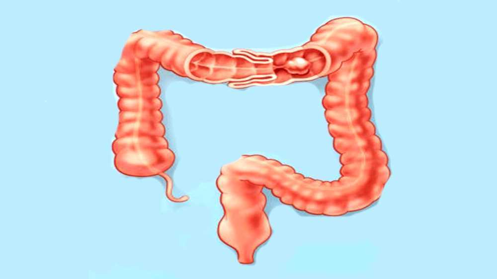 Intussusception (medical disorder)