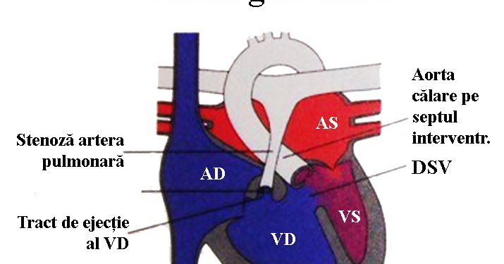 AMG: Cardiologie si nursing în cardiologie ,6 BOLILE CONGENITALE ALE INIMII